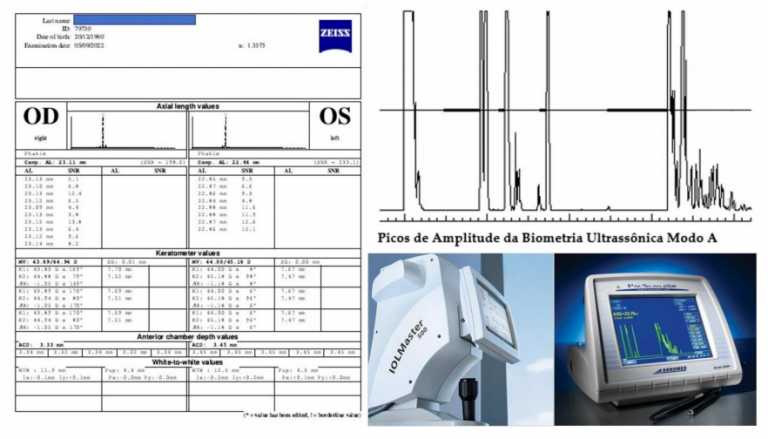 Biometria Ultrassônica e Biometria Óptica (Iol Master) - Oftalmologia RPL