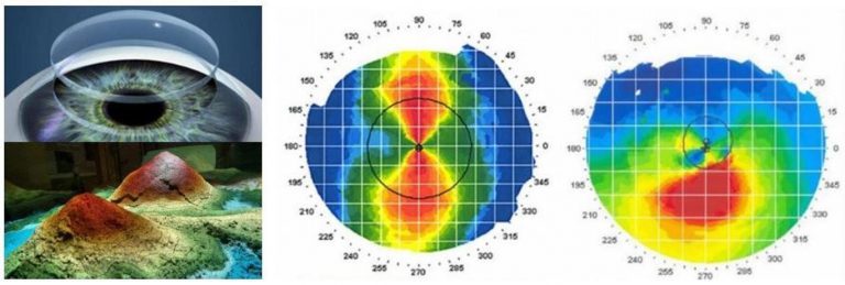 Ceratoscopia Computadorizada (Topografia Corneana) - Oftalmologia RPL